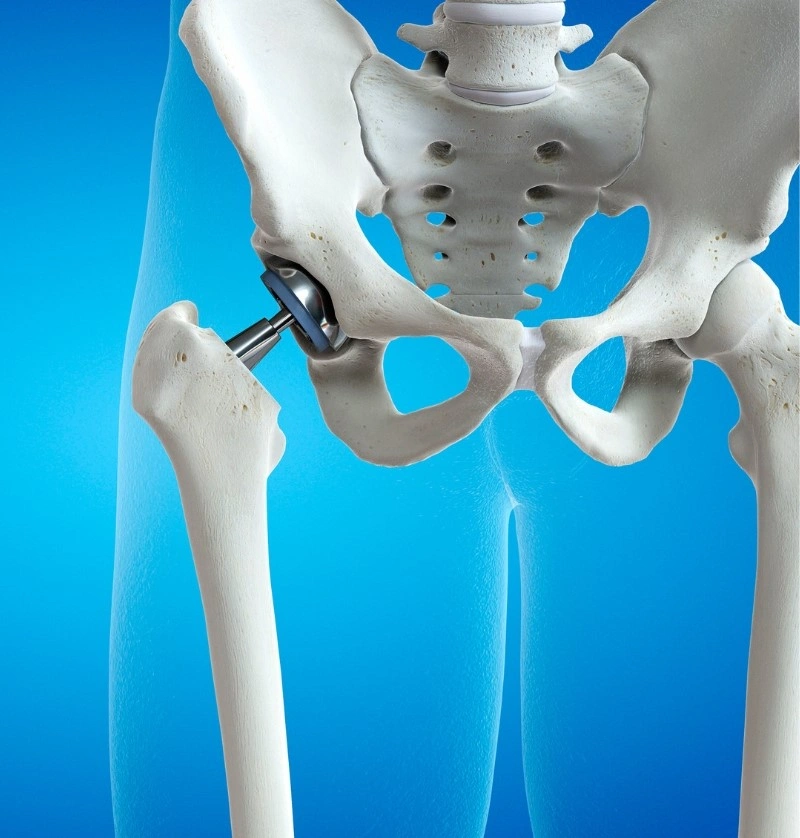 Medical Device Engineering & Product Development-SARACA